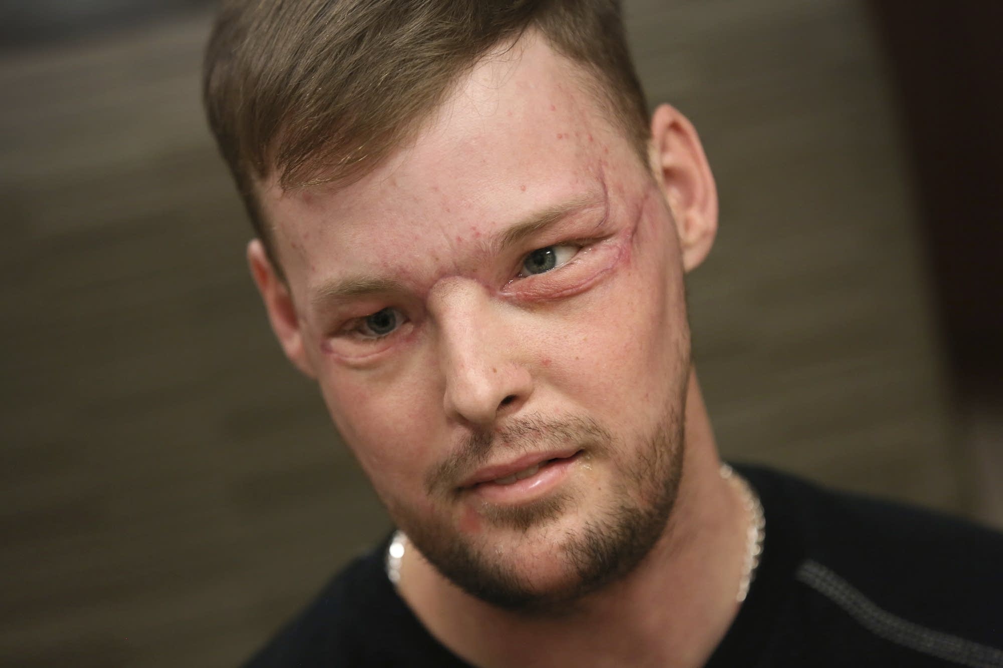 Twin tragedies give survivor a new face at Mayo Clinic | MPR News