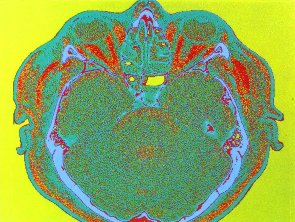 Decoding brain development | MPR News