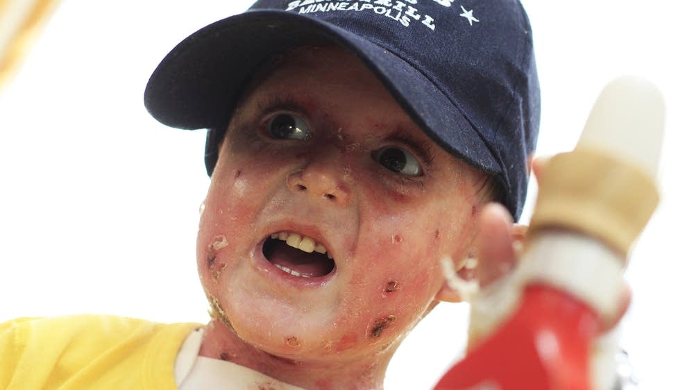 For those with rare skin disease, U of M treatment gives first-ever ...