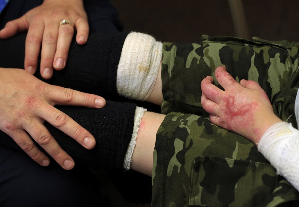 For those with rare skin disease, U of M treatment gives first-ever ...