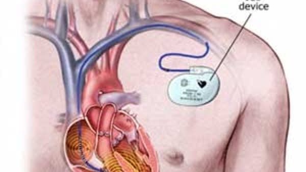 Study tracks malfunctions of heart devices | MPR News