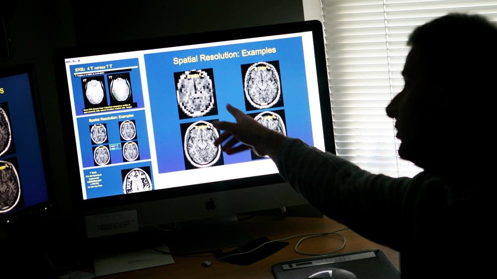 Study mapping brain's connections to provide answers on what's normal ...