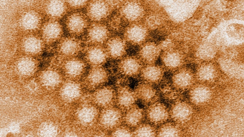 Norovirus Strain Hits Minnesota 20 Outbreaks Reported MPR News